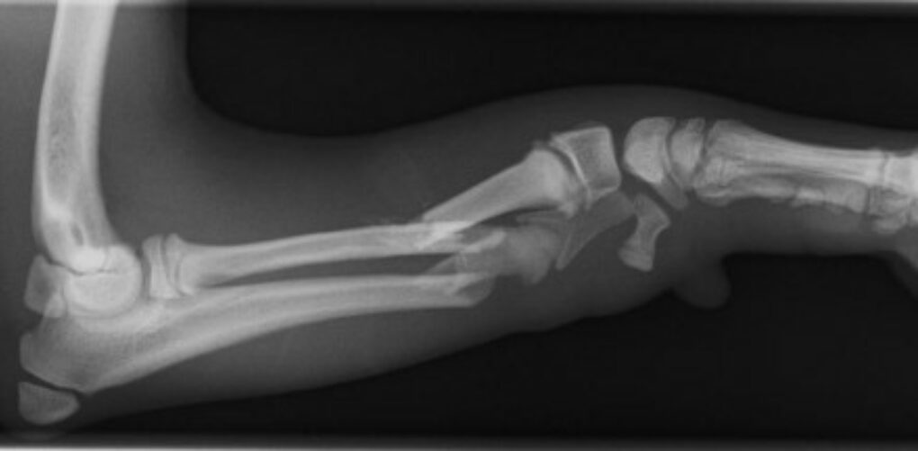 Botbreuken - Dierenartsen Noorderplantsoen